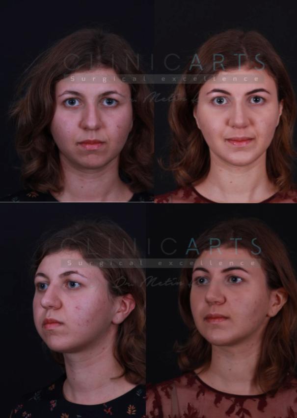 Is Bichectomy (Buccal fat removal) a non surgical procedure? What is ...